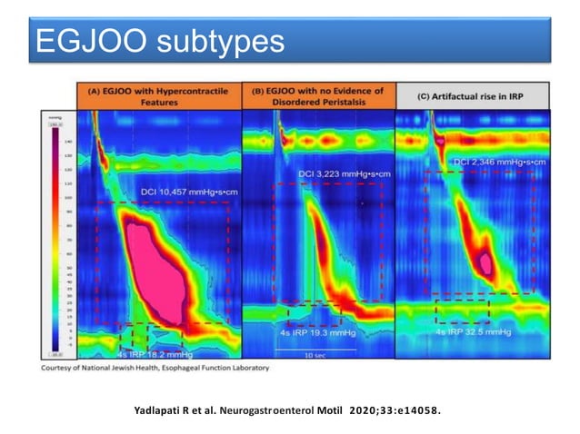Chicago classification version 4.0: HRM classification of esophageal ...