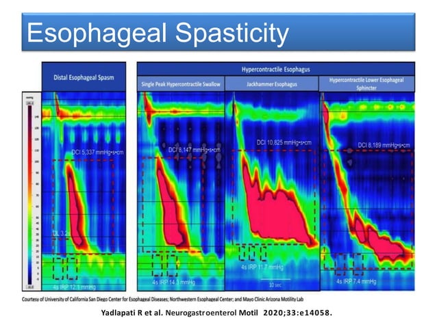Chicago classification version 4.0: HRM classification of esophageal ...