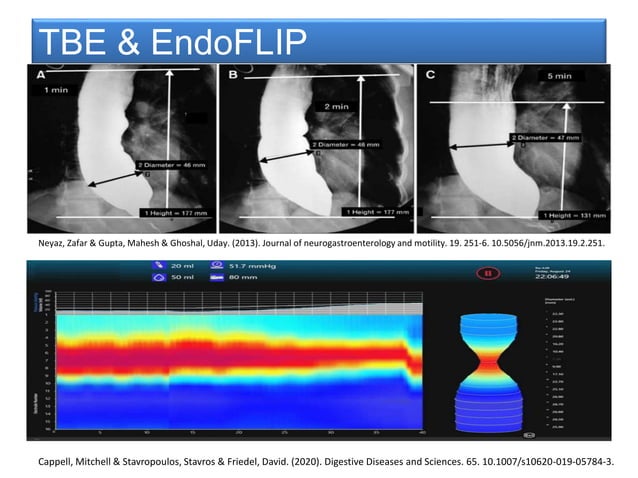 Chicago classification version 4.0: HRM classification of esophageal ...
