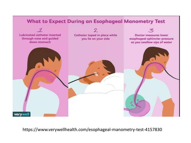 Chicago classification version 4.0: HRM classification of esophageal ...