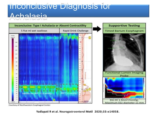 Chicago classification version 4.0: HRM classification of esophageal ...