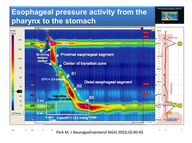 Chicago classification version 4.0: HRM classification of esophageal ...