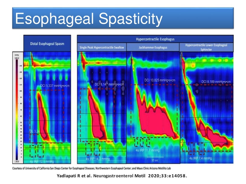 Chicago classification version 4.0: HRM classification of esophageal