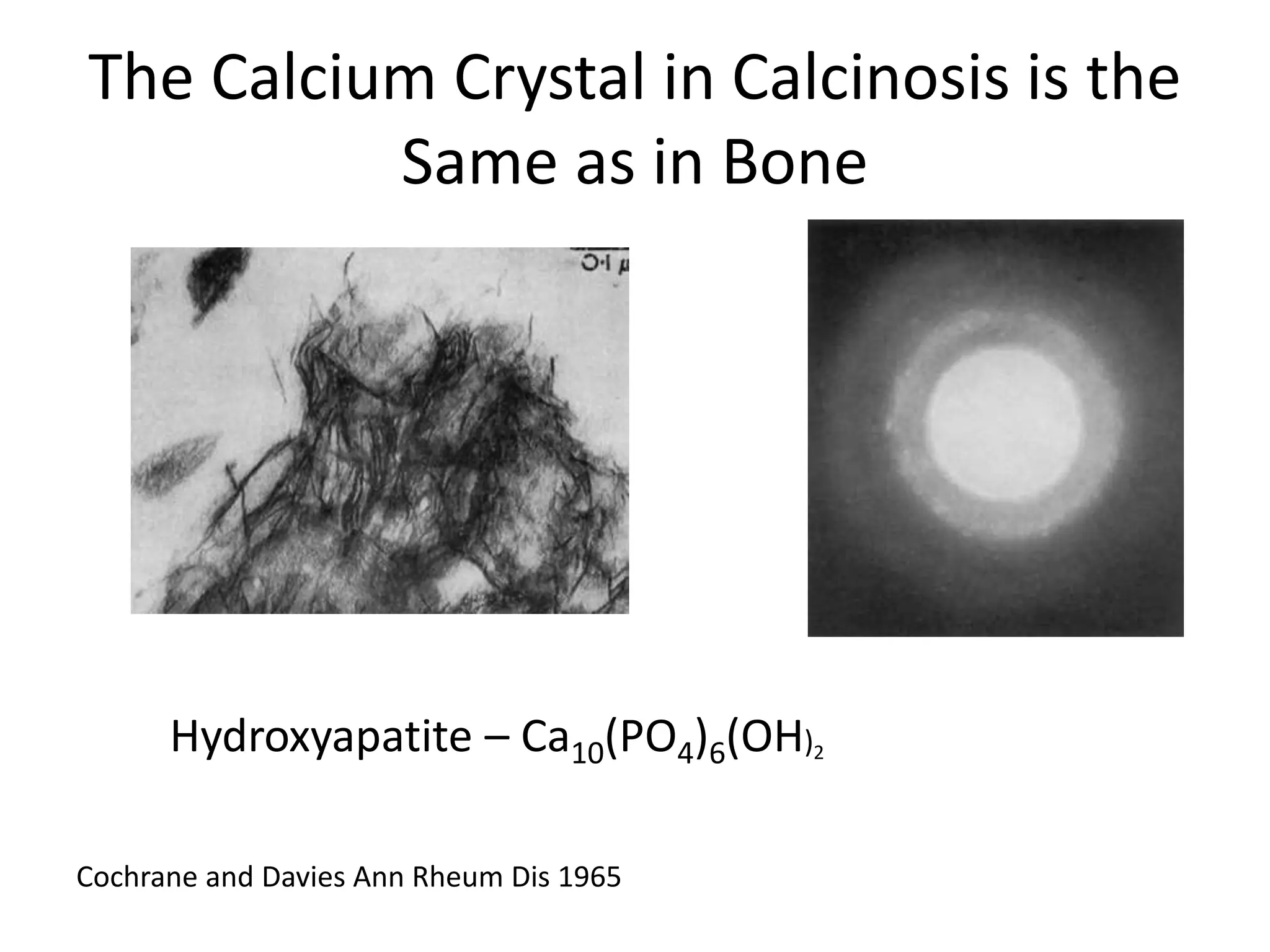 Scleroderma & the hands - Calcinosis | PPT