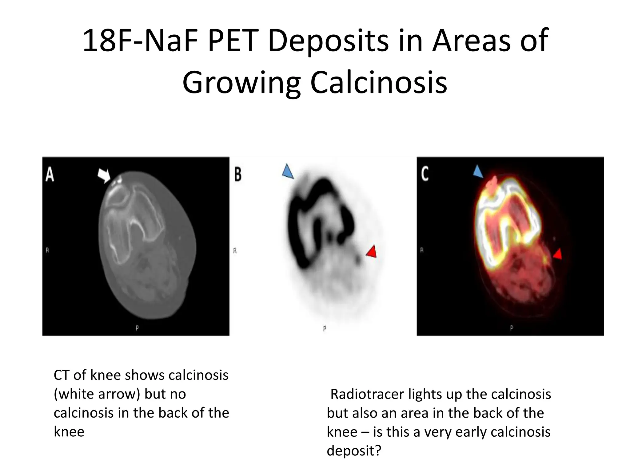 Scleroderma & the hands - Calcinosis | PPT