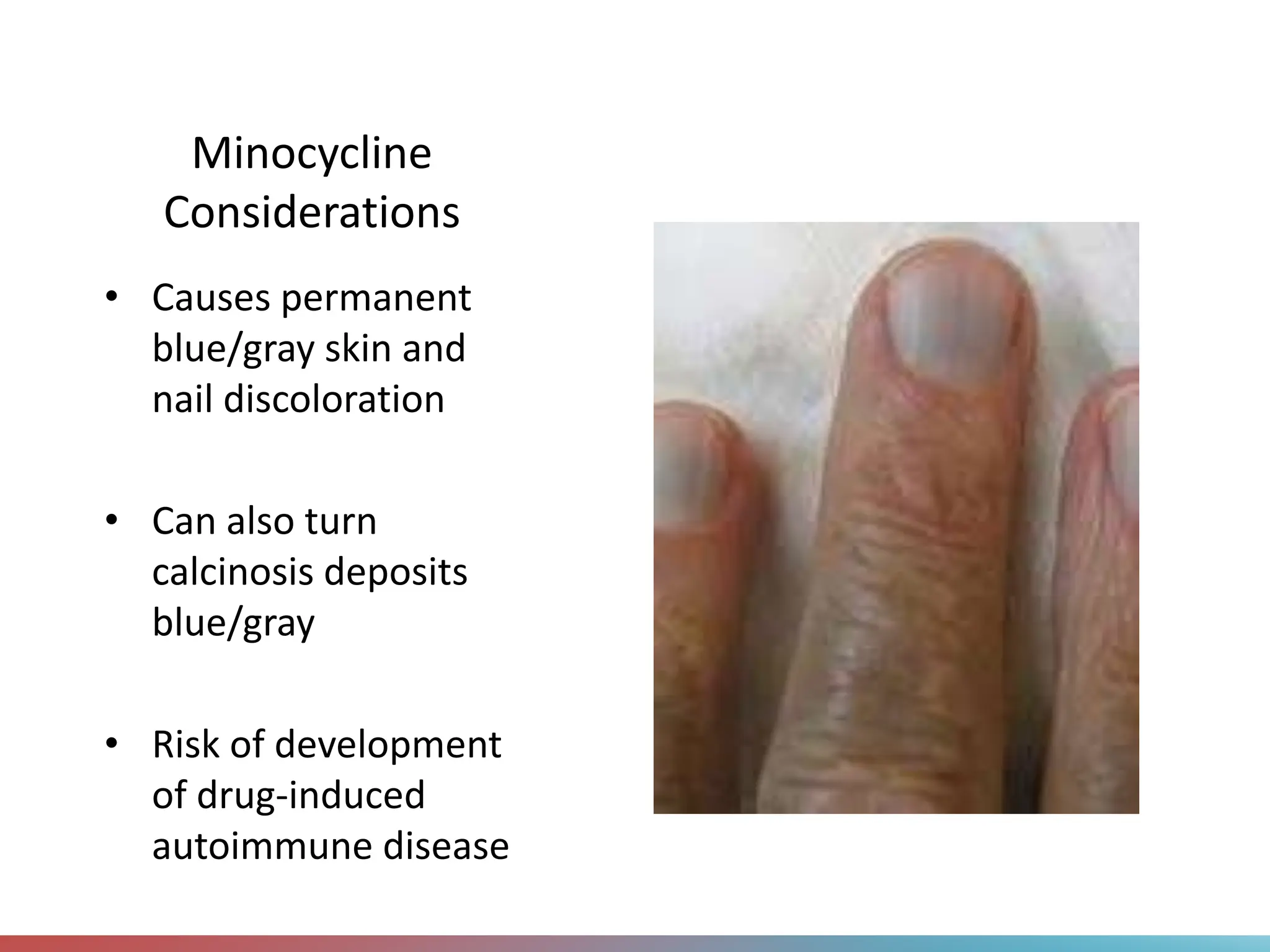 Scleroderma & the hands - Calcinosis | PPT