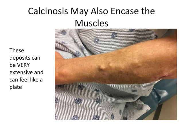 Scleroderma & the hands - Calcinosis | PPT