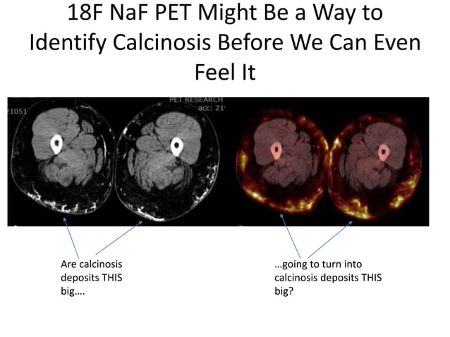 Scleroderma & the hands - Calcinosis | PPT