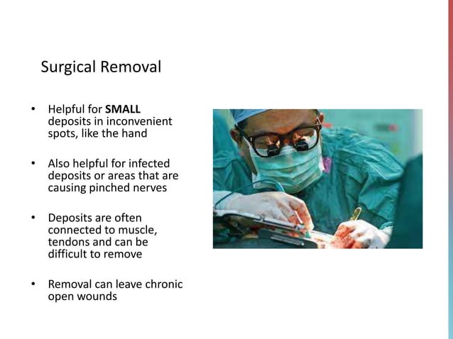 Scleroderma & the hands - Calcinosis | PPT