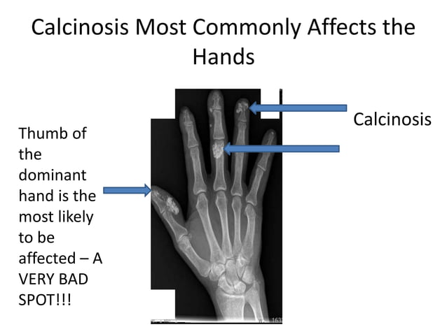 Scleroderma & the hands - Calcinosis | PPT