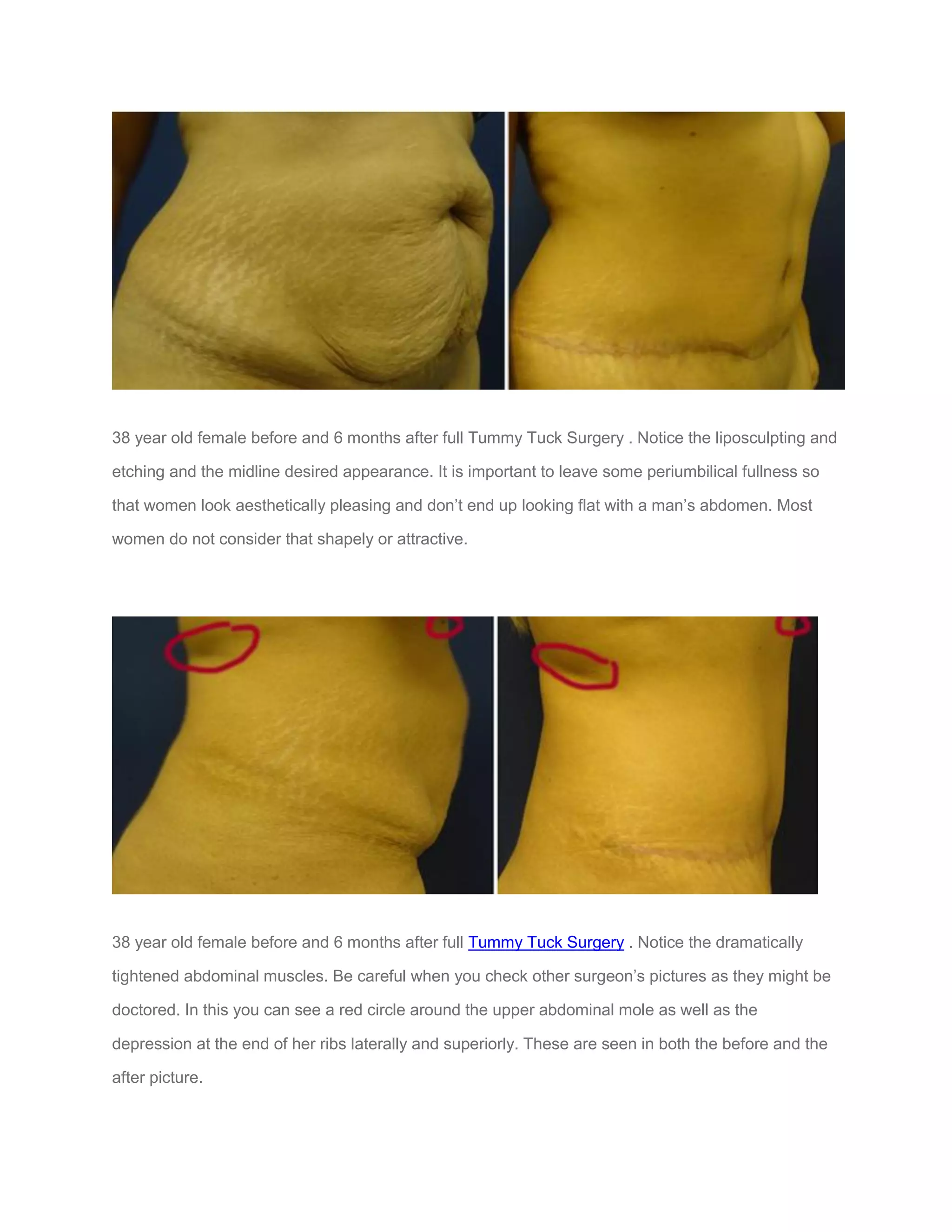 Chicago Tummy Tuck Pictures & Abdominoplasty Surgery Before And After ...