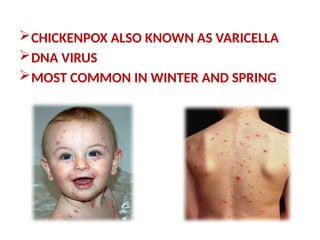 chicken box symptoms ,and zoster virus.pptx