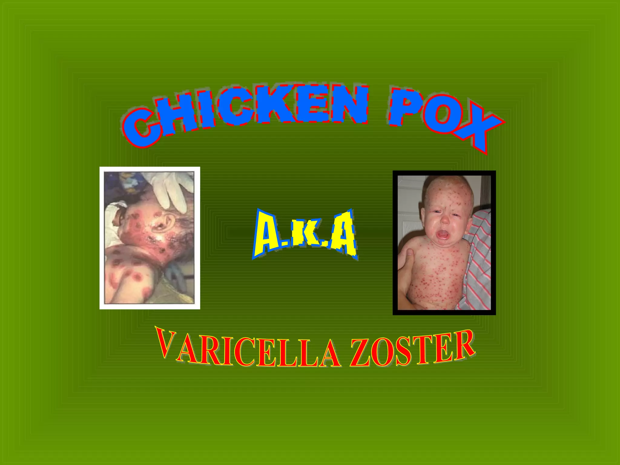 Chicken Pox | PPT