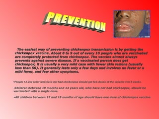 Chicken Pox | PPT