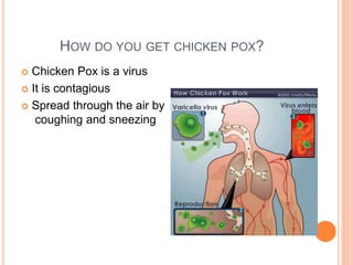 Chicken pox | PPT