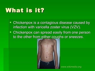 Chickenpox | PPT