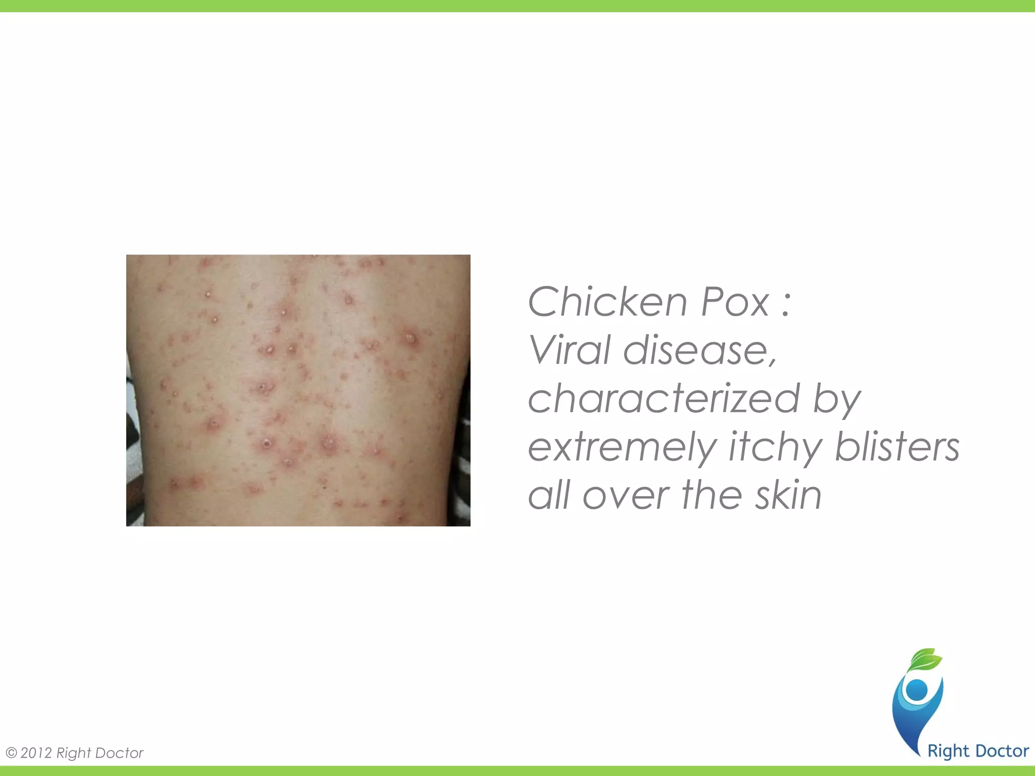 Chickenpox | PPT
