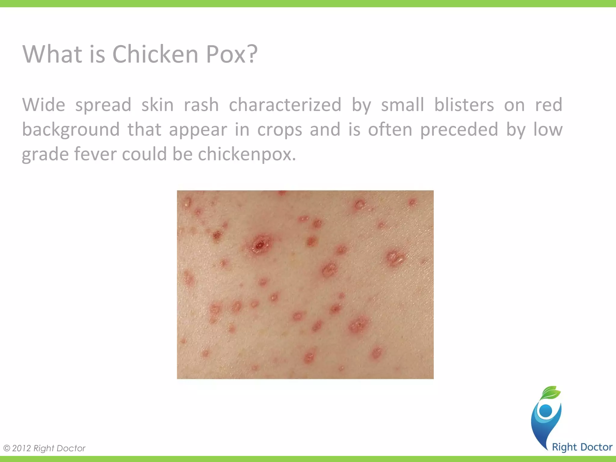 Chickenpox | PPT