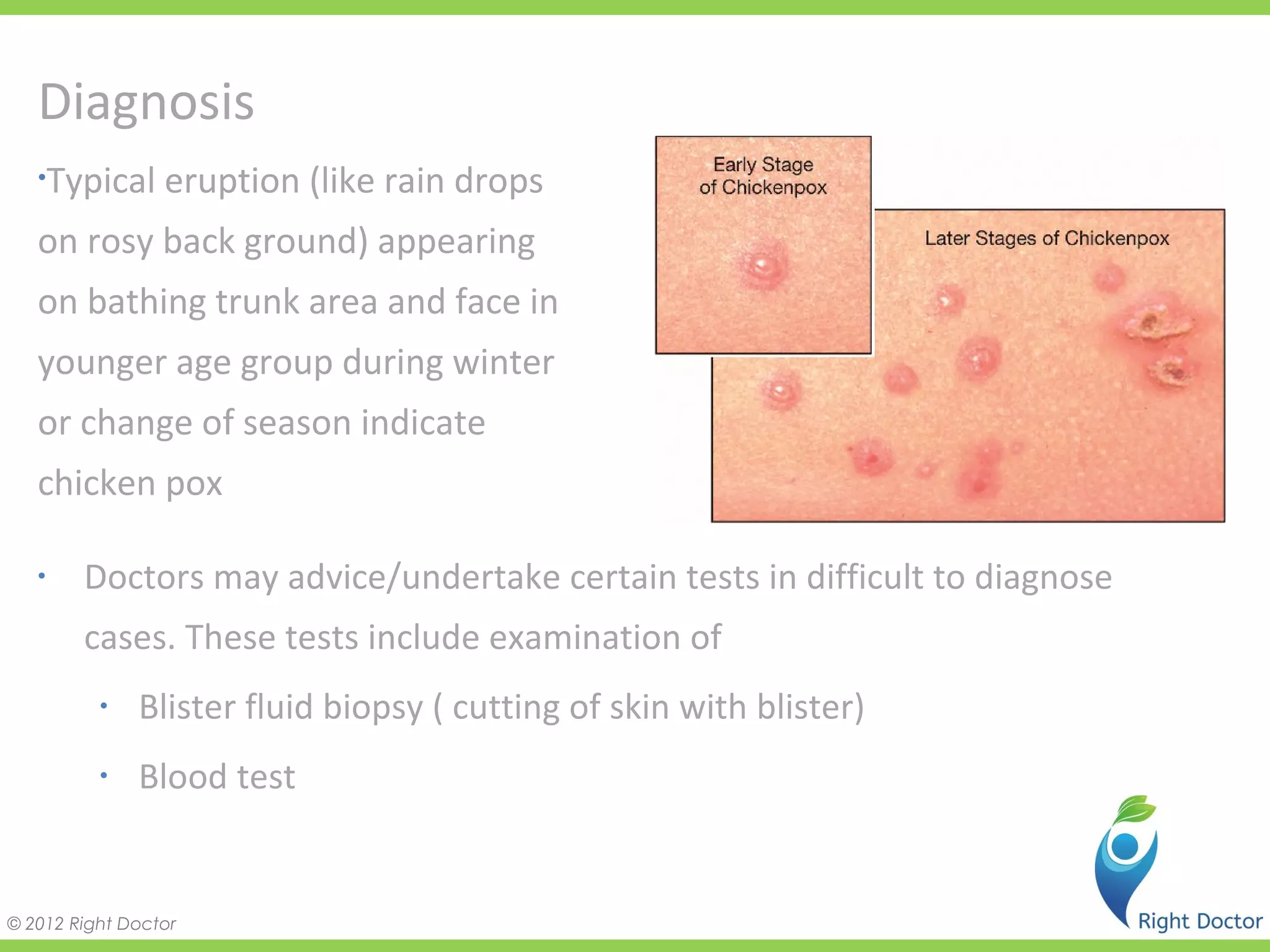 Chickenpox | PPT