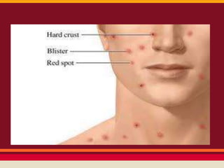 Chickenpox | PPTX