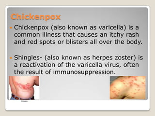 Chickenpox | PPTX