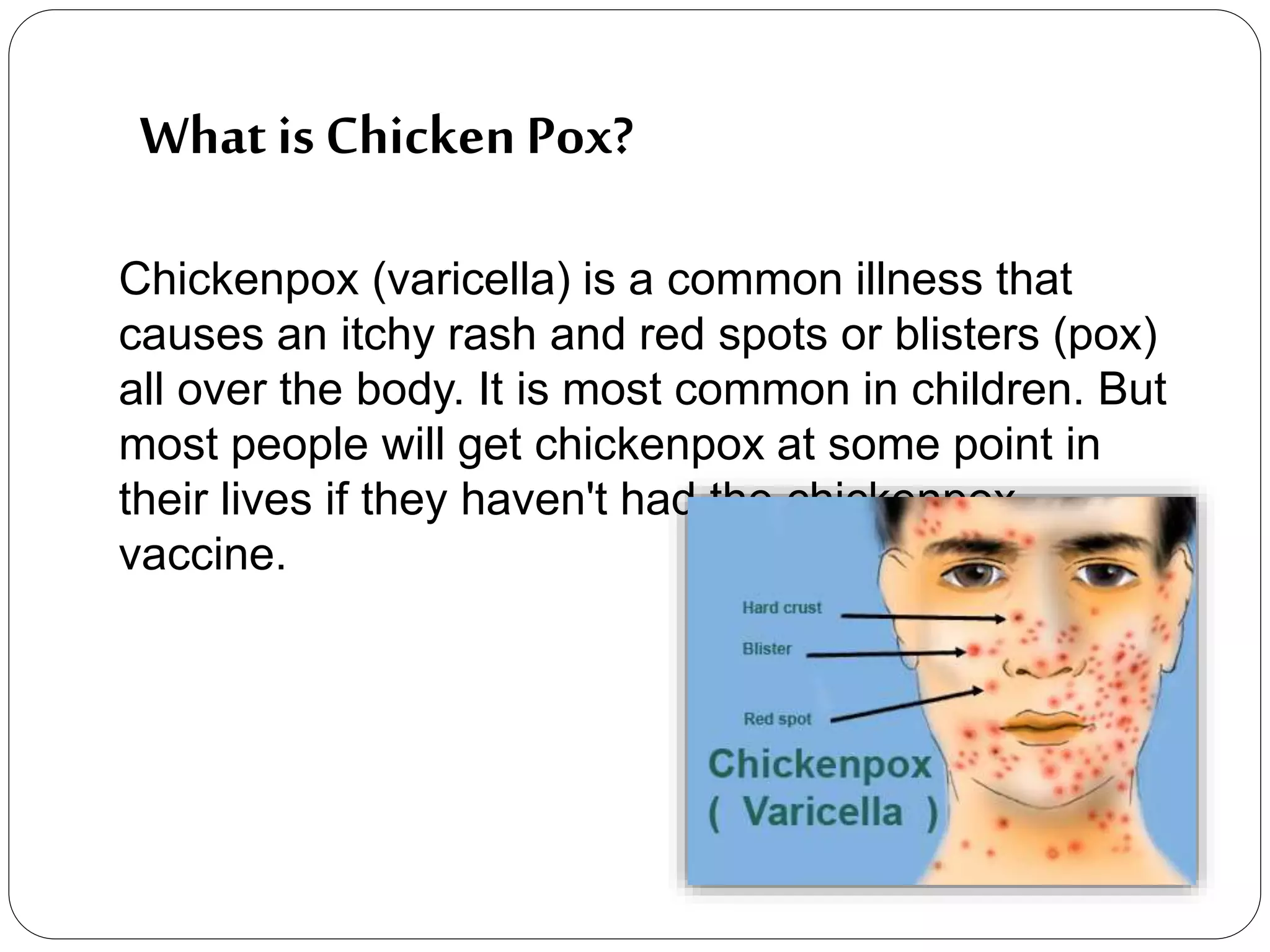 Chicken pox | PPT
