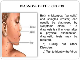 Chicken pox | PPTX