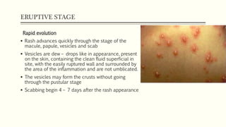 Chickenpox | PPTX