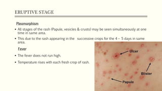 Chickenpox | PPTX