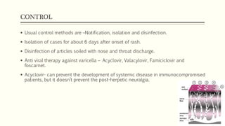 Chickenpox | PPTX