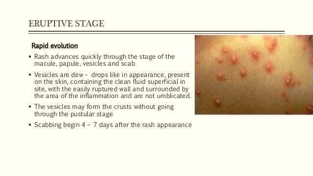 Chicken Pox Macule Stage