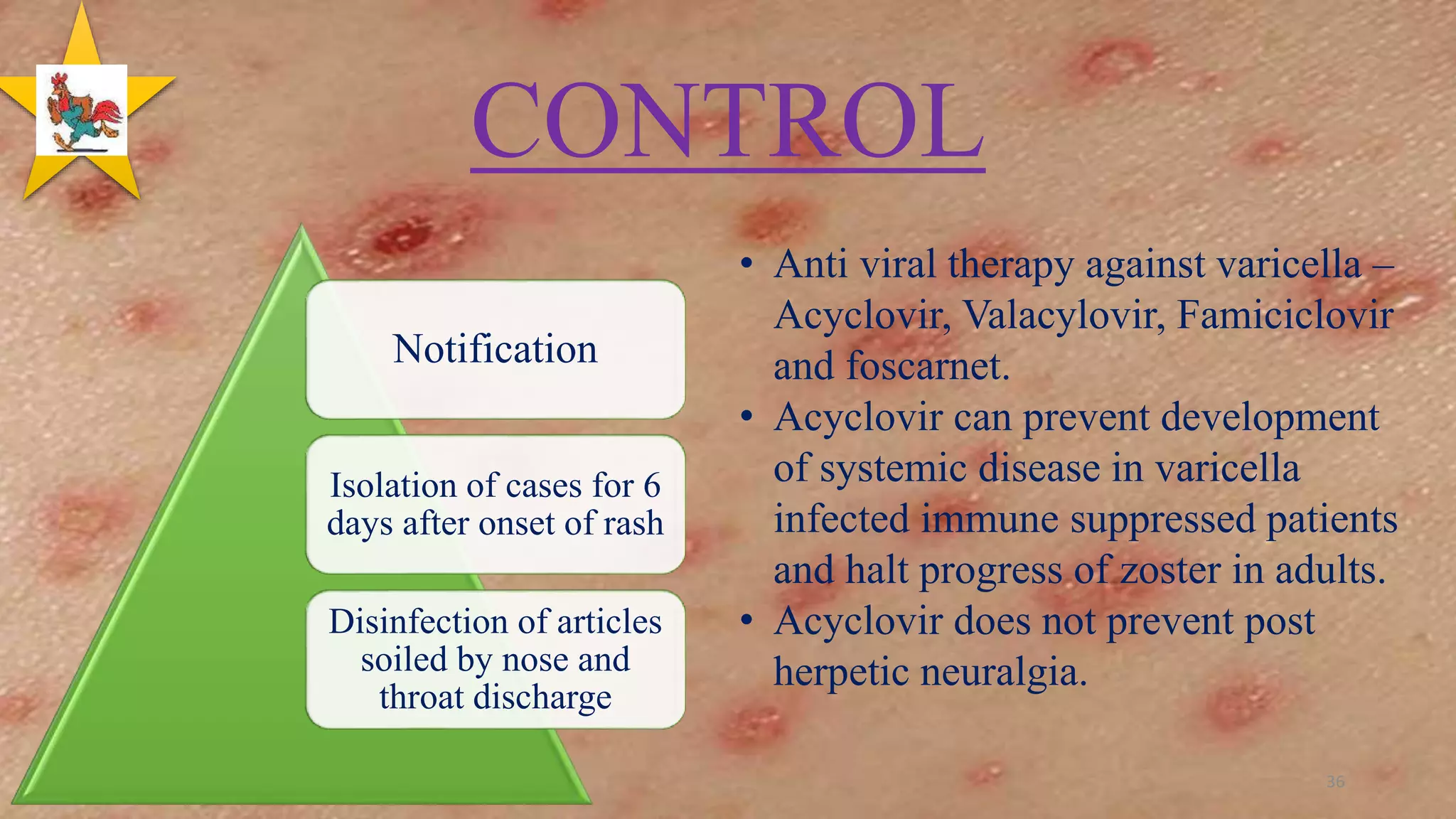 Chickenpox | PPTX