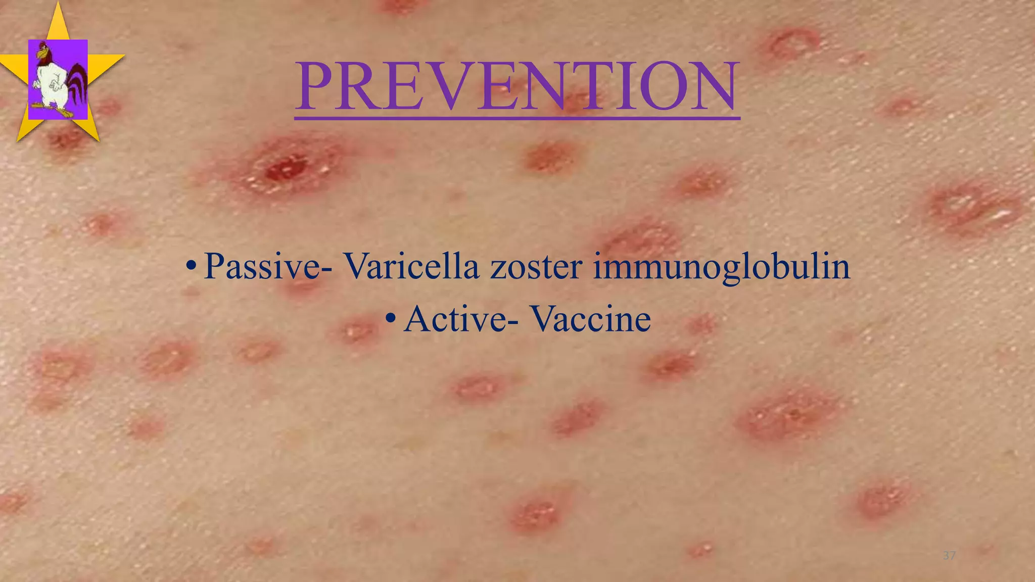 Chickenpox | PPTX