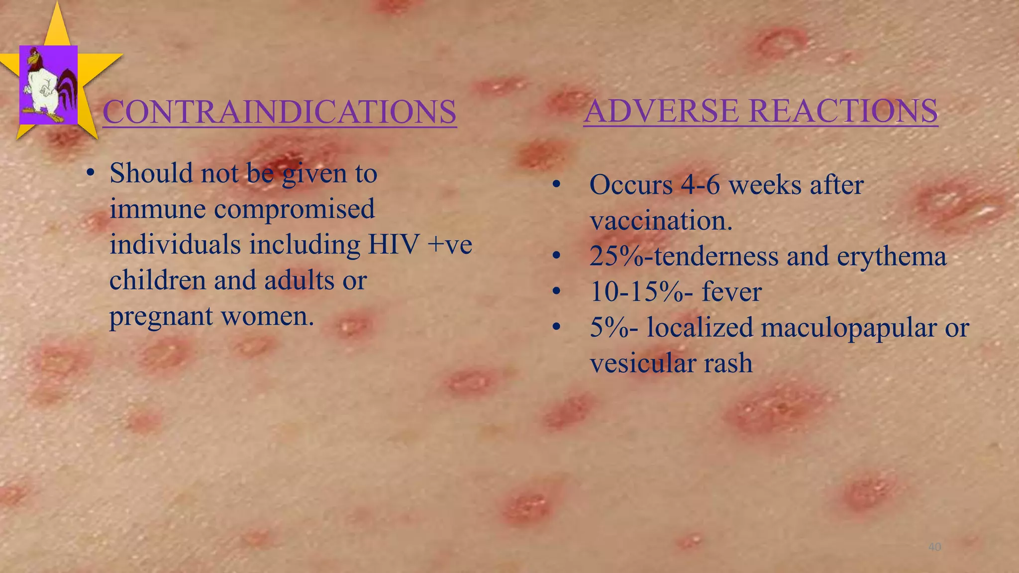 Chickenpox | PPTX