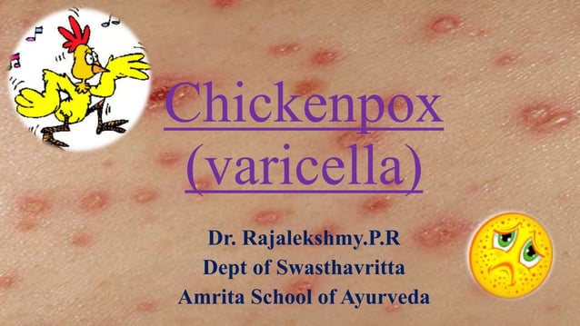 Chickenpox | PPTX | Infectious Diseases | Diseases and Conditions