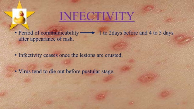 Chickenpox | PPTX | Infectious Diseases | Diseases and Conditions