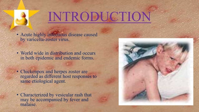 Chickenpox | PPTX | Infectious Diseases | Diseases and Conditions