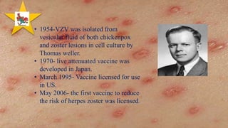 Chickenpox | PPTX