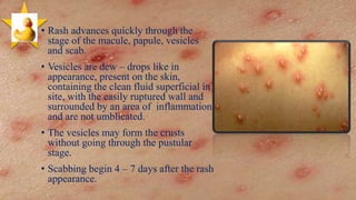 Chicken Pox Macule