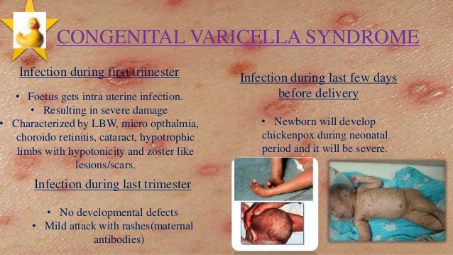 Congenital Varicella Syndrome