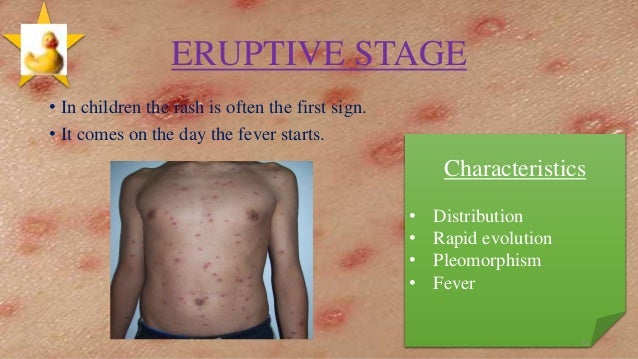 Chicken Pox Macule Stage