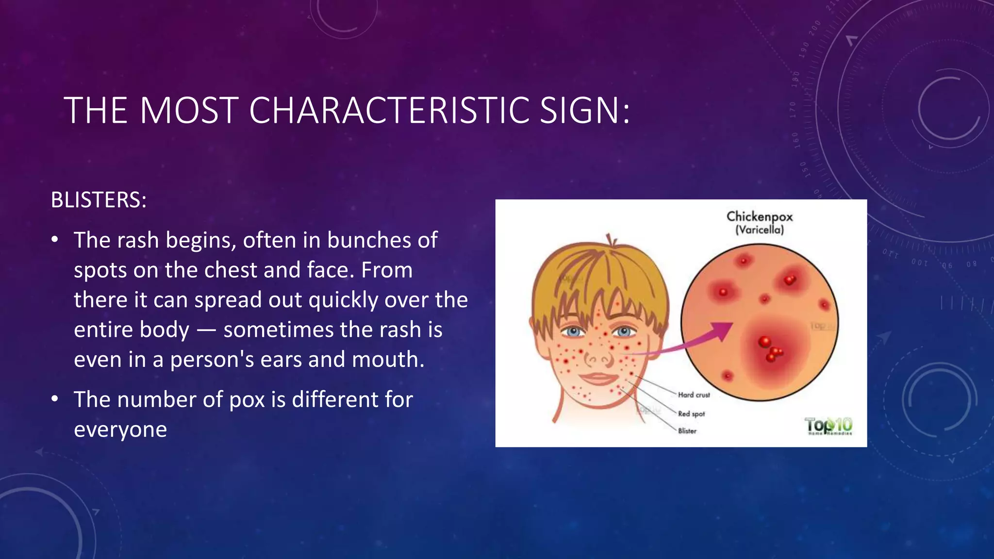 Chickenpox | PPTX
