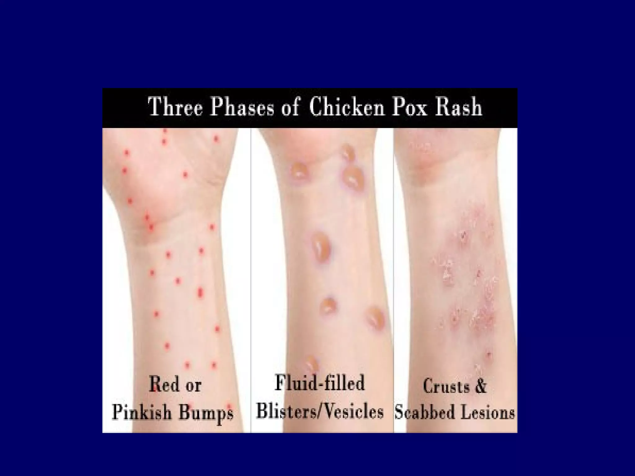 Chickenpox | PPT