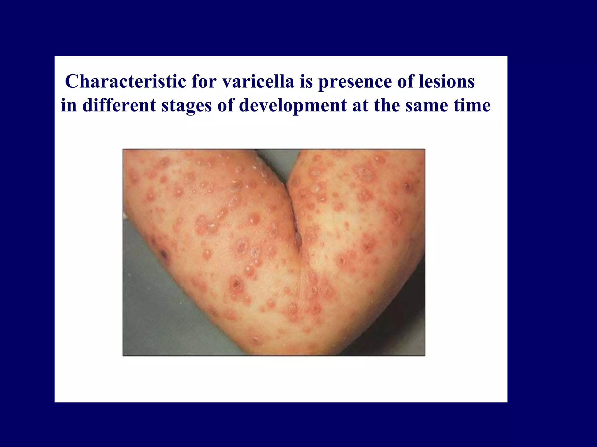 Chickenpox | PPT