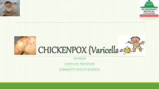 Epidemiology and control measures for CHICKENPOX {Varicella} | PPTX