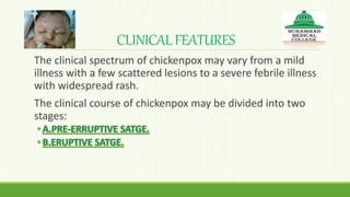 Epidemiology and control measures for CHICKENPOX {Varicella} | PPTX