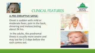 Epidemiology and control measures for CHICKENPOX {Varicella} | PPTX