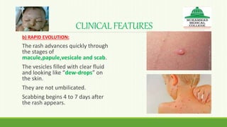 Epidemiology and control measures for CHICKENPOX {Varicella} | PPTX