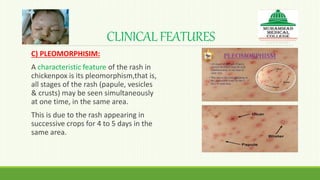 Epidemiology and control measures for CHICKENPOX {Varicella} | PPTX