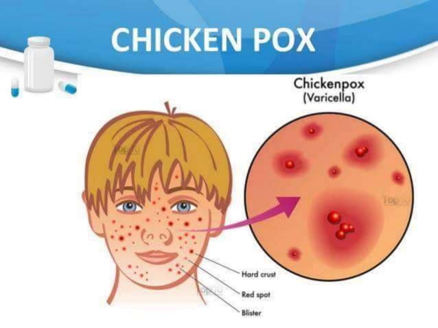 Chicken pox | PDF | Skin and Dermatology | Diseases and Conditions